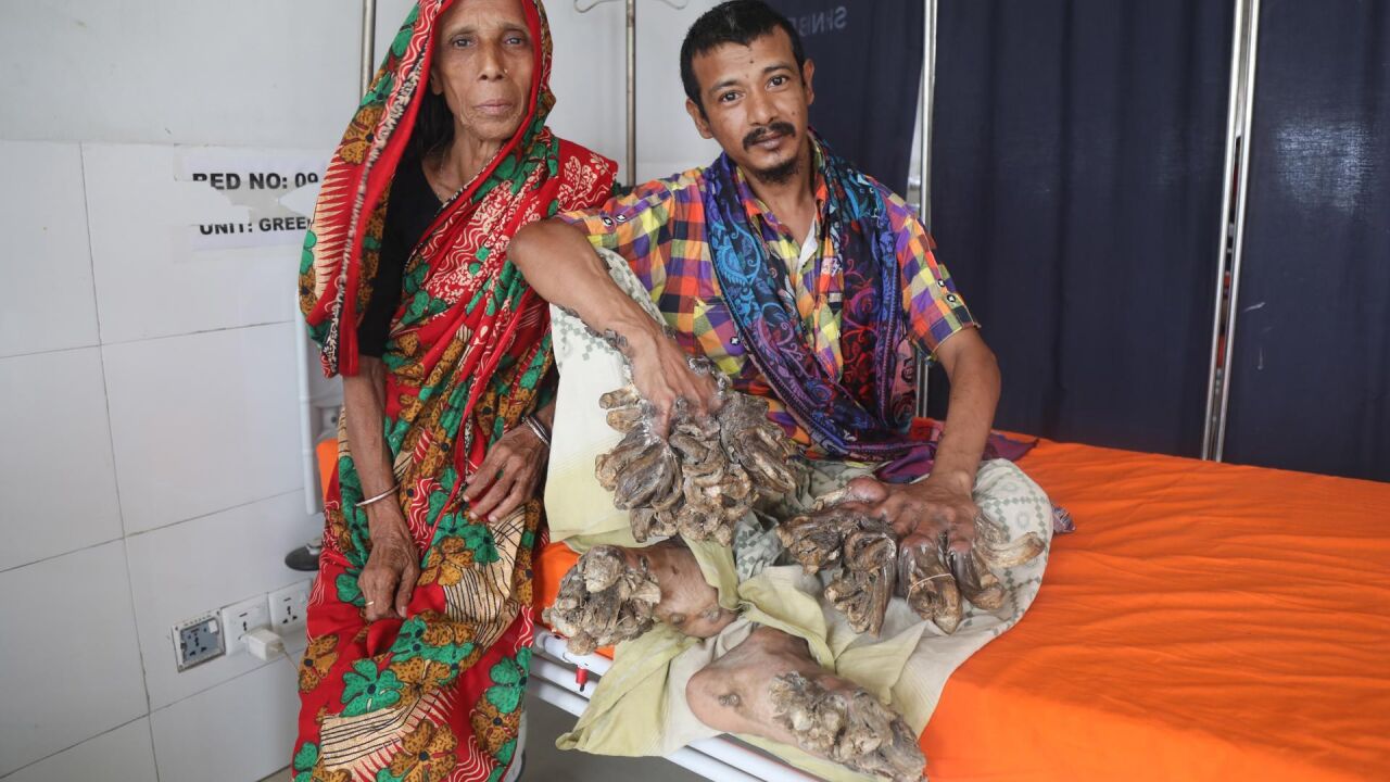 El famoso "hombre árbol" de Bangladesh vuelve a estar hospitalizado